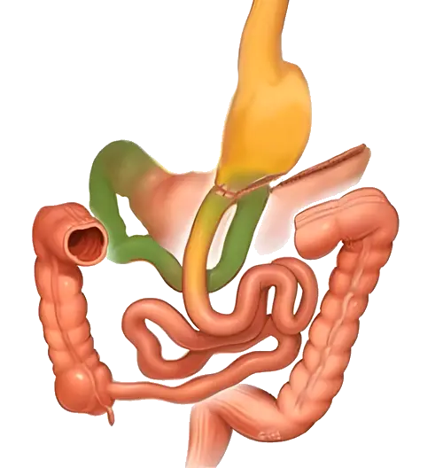 Bypass Gastroileal en Lima - Cirugía de Obesidad y Diabetes en Lima ...